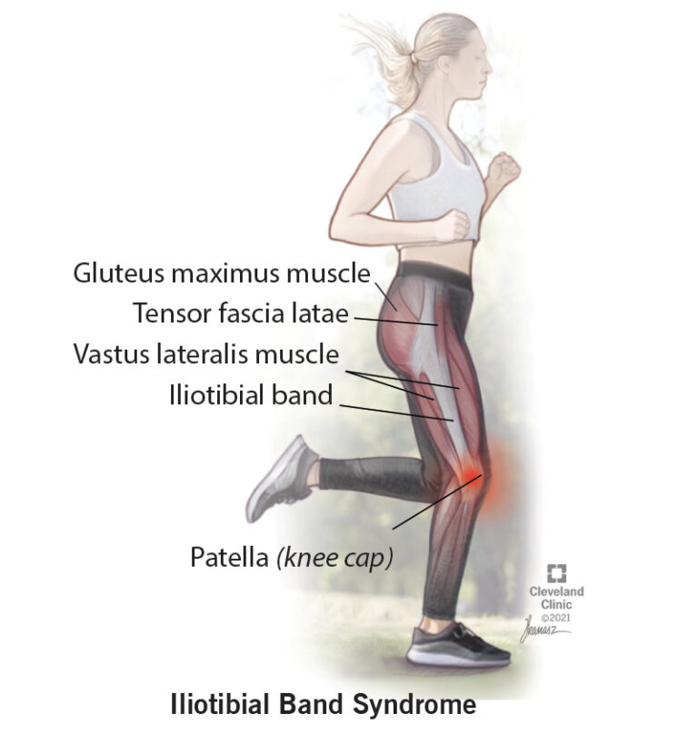 Iliotibial Band Syndrome – Kamala Devi Hospital