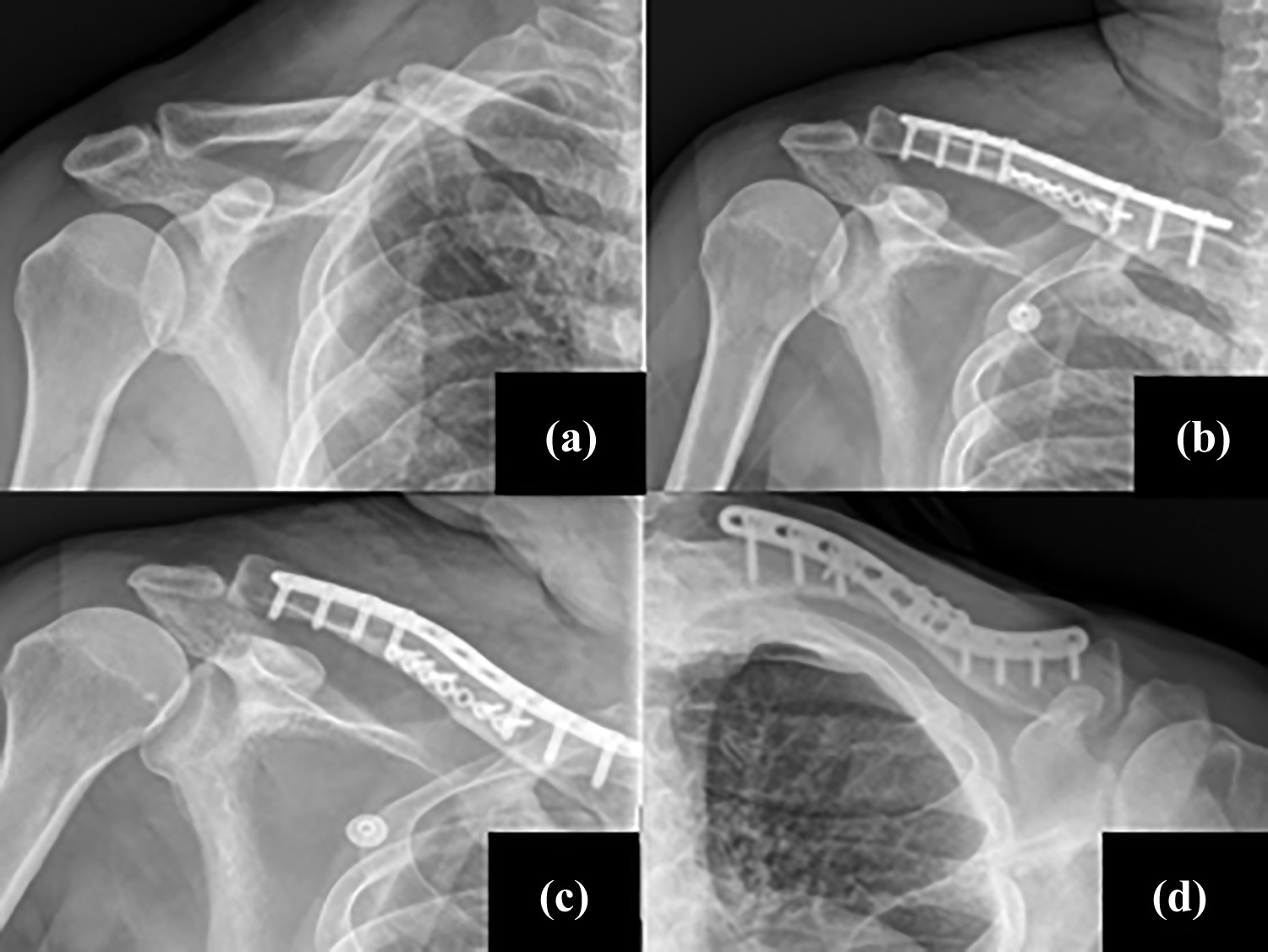 Clavicle Fracture Fixation – Kamala Devi Hospital